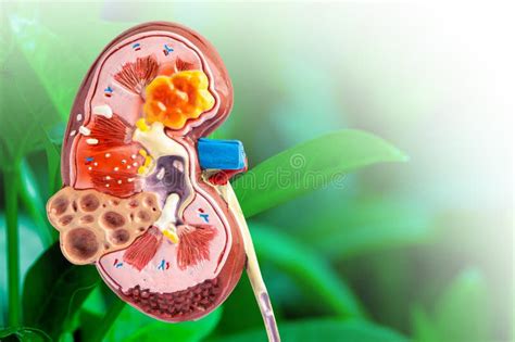 Kidney Disease Chronic Kidney Disease Ckd Doctor Hold Human Model To Treat And Study In