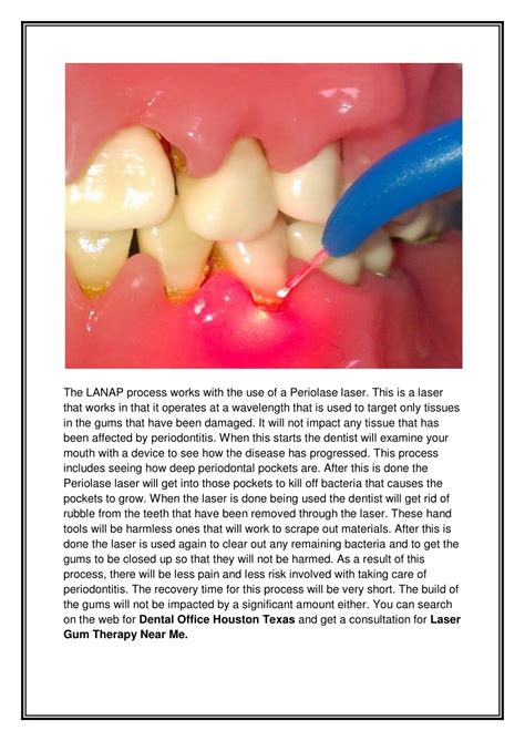 Ppt Why Lanap Procedure Is Important For Getting Rid Of Gum Infection