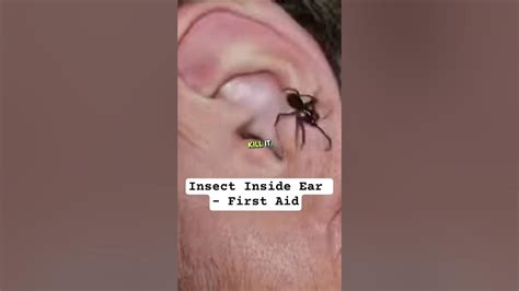 Insect Inside Ear First Aid Simple Steps To Handle It Youtube
