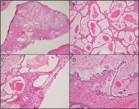 A Low Power Photomicrograph Of Clear Cell Lesion In Leep Specimen