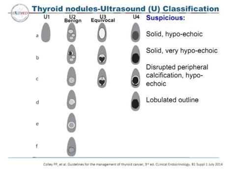 Thyroid Nodules And Cancer