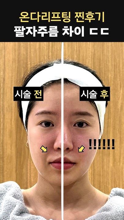 온다리프팅 후기 Shorts 온다리프팅 온다리프팅후기 팔자주름 주름 피부관리 Youtube