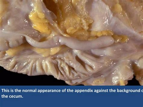 Appendix Gross Pptx