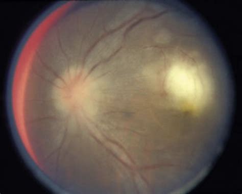 Retinal Inflammation Flashcards Quizlet