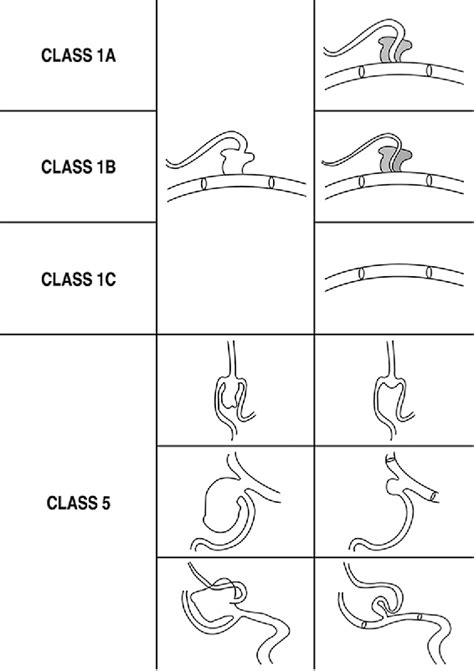Figure 1 From A New Aneurysm Occlusion Classification After The Impact