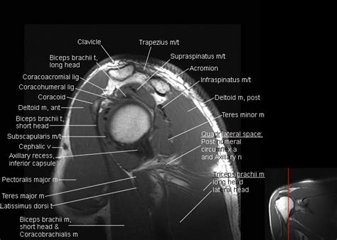 Mri Anatomy Shoulder Quantitative Assessment Of Rotator Cuff Injuries
