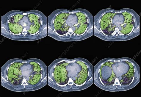 Interstitial Lung Disease Ct Scan Stock Image C Science Photo Library