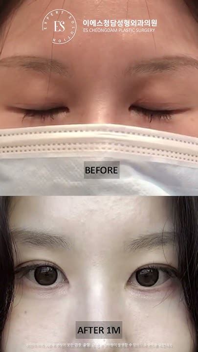 전체적으로 자연스럽고 시원하게 커지는 눈으로 어려보이는 눈매 원해요💕쌍수후기눈재수술 자연유착 윗트임 Youtube