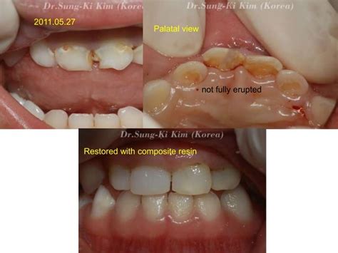 Restoring Primary Anterior Teeth With Esthetic Crowns Pptx Dental