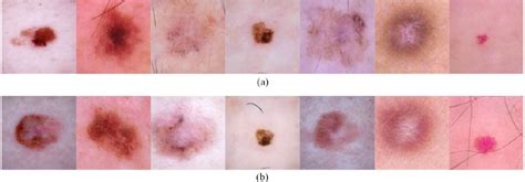 Figure From A GAN Based Data Augmentation Method For Imbalanced Multi Class Skin Lesion