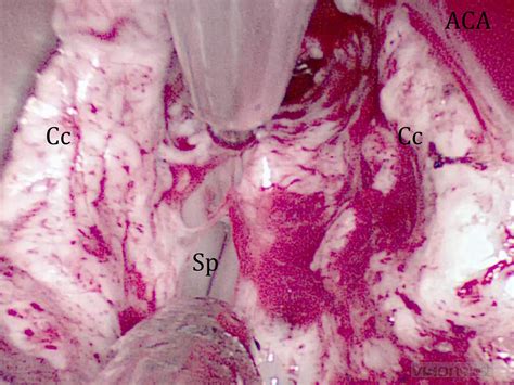Corpus Callosotomy The Neurosurgical Atlas