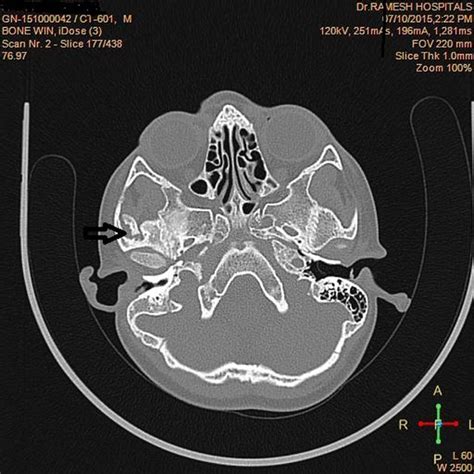 Pdf An Unusual Anterior Dislocation Of Fractured Mandibular Condyle