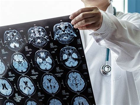 Hiv Encephalopathy Definition Symptoms And Treatments