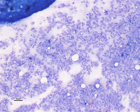 Mds Archives Eclinpath