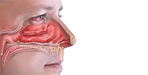 Iritativni Rinitis Zdravlje