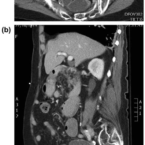 Radiology Of Tube Ileostomy Site Without Any Sign Of Stricture Or