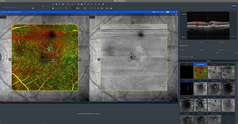 Type 3 Macular Neovascularization Retinography
