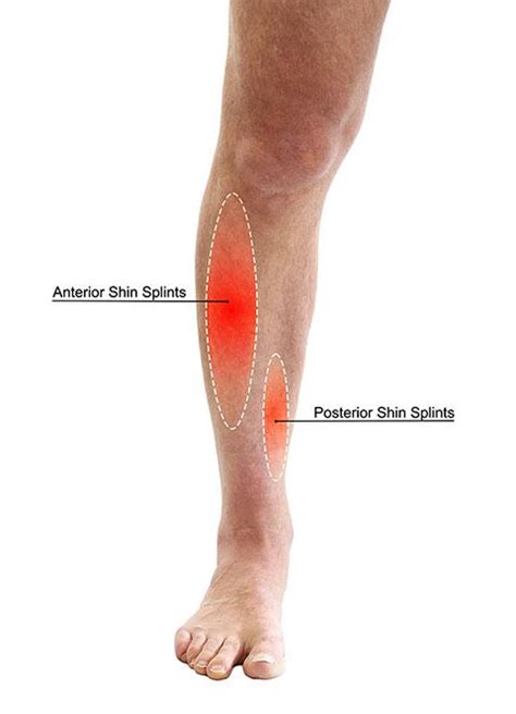 Shin Splints Orthopaedic Wellness Links