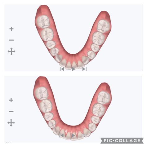 Got Access To My Clincheck Today R Invisalign