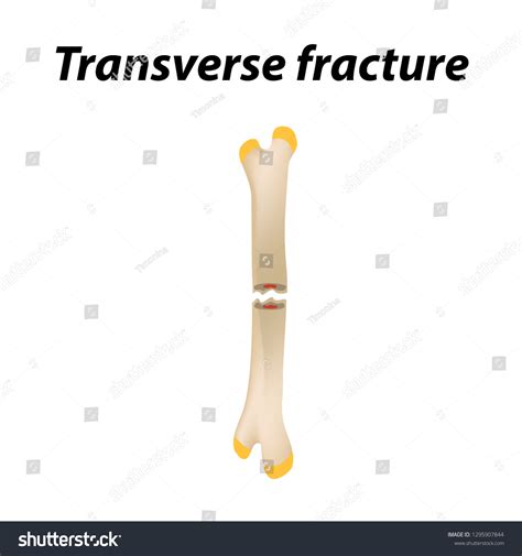 Transverse Bone Fracture Infographics Vector Illustration 스톡 벡터 로열티 프리 1295907844 Shutterstock