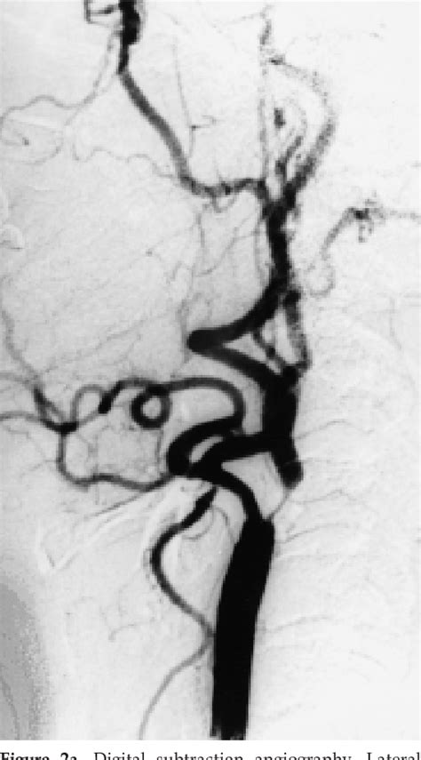 [pdf] Cerebral Hyperperfusion Syndrome After Carotid Angioplasty Semantic Scholar