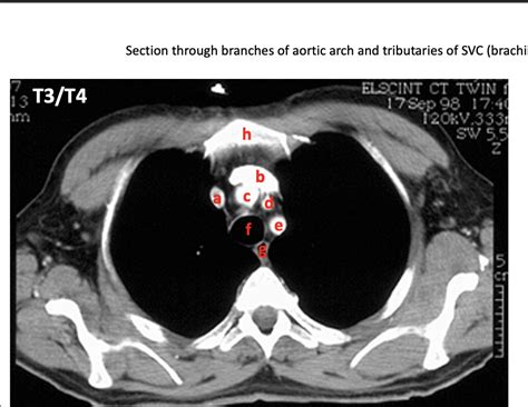 Ct Portion Of Mediastinum Lecture Diagram Quizlet