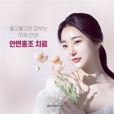 안면홍조 혈관확장증 딸기코 울긋불긋 피부 퀀타레이저 585 효과 비용 Ldm 홍조 피부관리 대구 반월당 고운미피부과 네이버 블로그