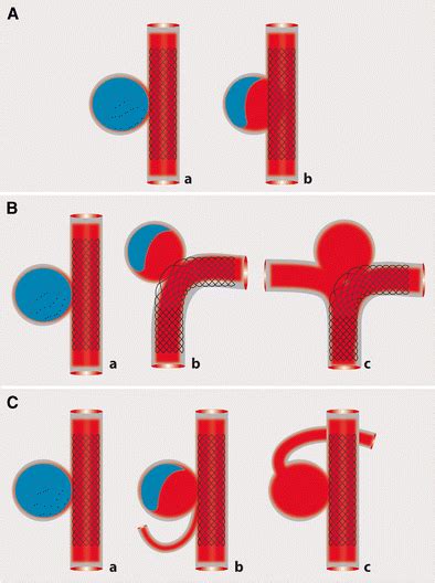 Aneurysm Related Factors Influencing Results Of Flow Diversion A
