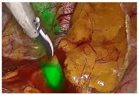Pelvic Sentinel Lymph Node Biopsy For Endometrial Cancer With Multi Modal Infrared Signal