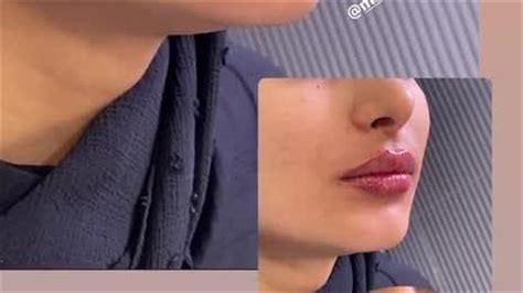 عکس قبل و بعد تزریق ژل لب کلینیک مهزیار نماشا