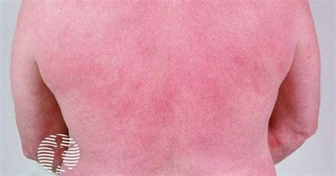 Plant Dermatitis Image