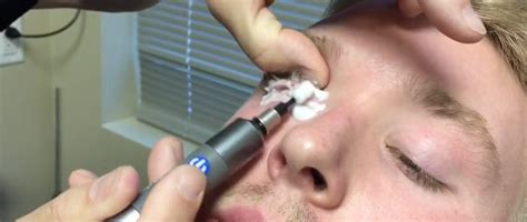 Comparison Of Blephex Treatment And Sham For Managing Blepharitis