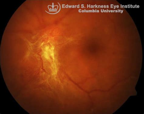 Neovascularization Of The Disc Vagelos College Of Physicians And Surgeons