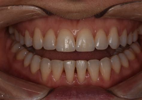 Case 3 Traditional Braces Private And Cosmetic Dentist In Warrington