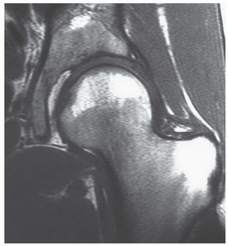 Diffuse Marrow Diseases Musculoskeletal Key Diffuse Marrow Diseases Musculoskeletal Key