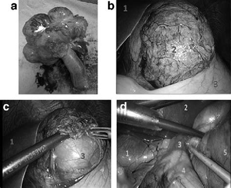 A Distal Ileum And Cecal Resection Specimen B View Of The Lesser Download Scientific