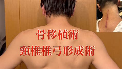 【頸椎椎弓形成骨移植術】頸椎症性脊髄症と頸部脊柱管狭窄症を発症し手術することを選択したが予想以上に辛かった Youtube