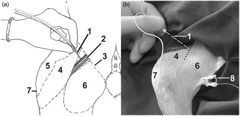 Femoral Nerve Block Landmarks