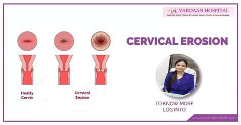 Cervical Erosion Dr Dimple Doshi
