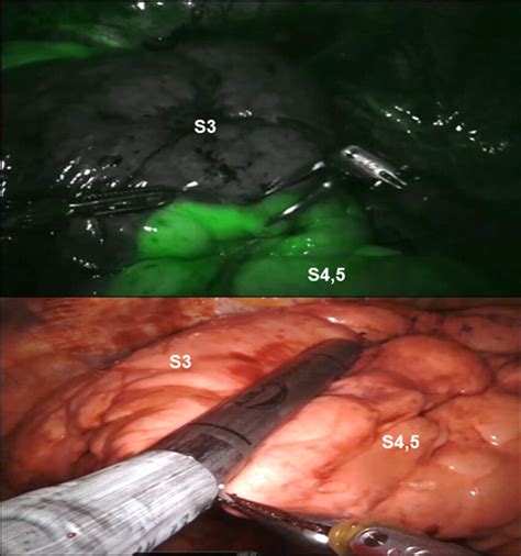 Ls3 Segmentectomy The Intersegmental Fissure Between S3 And S4 5 Is Download Scientific