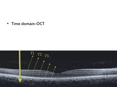 Optical Coherence Tomographyoct Macula Pptx