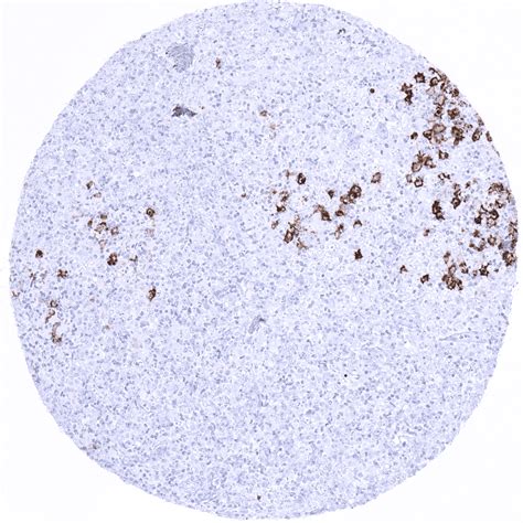 Cancer Tissue Gallery Cd1a Ms Validated Antibodies