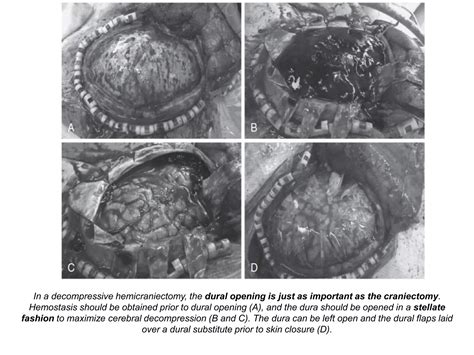 Decompressive Craniectomypptx