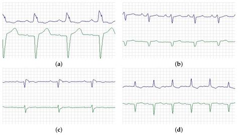 Arrhythmia Classification And Diagnosis Based On Ecg Signal A Multi Domain Collaborative