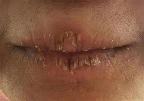 Angular Cheilitis And Eczema Like Hand Lesions In A 35 Year Old Woman