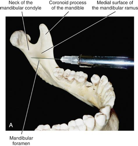 Landmarks For Mandibular Nerve Block At Anglea Ramos Blog