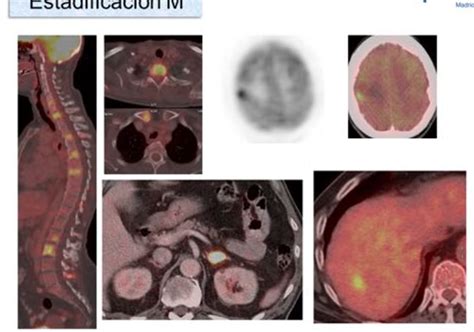 Figure 1 from IMAGEN PET-TC EN EL MANEJO DEL NODULO PULMONAR Y EN EL ...