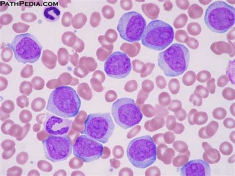 Researchers Fight Leukemia With Hiv