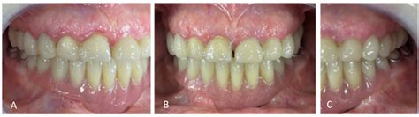 Full Mouth Digital Dental Rehabilitation Under General Anesthesia In A