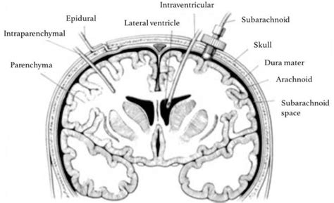 Icp Monitoring Types And Indications Neuropedia